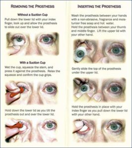 Monoplex Eye Prosthetics – Studley Ocular Labs – Resources Caring for ...